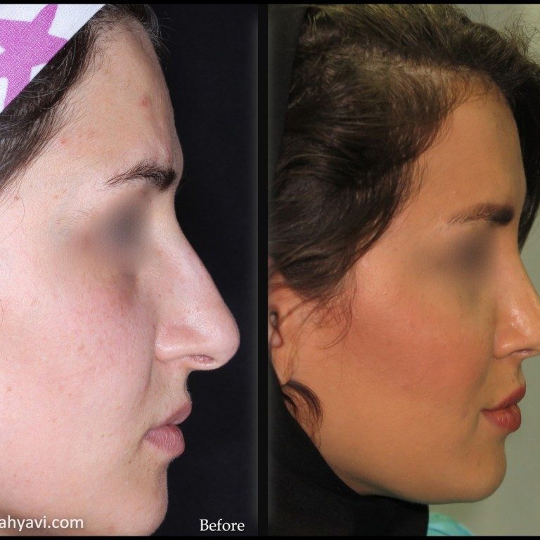 Thick Skin Noses (Meaty Noses)